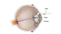 Laser Peripheral Iridotomy: Surgery for Narrow-Angle Glaucoma