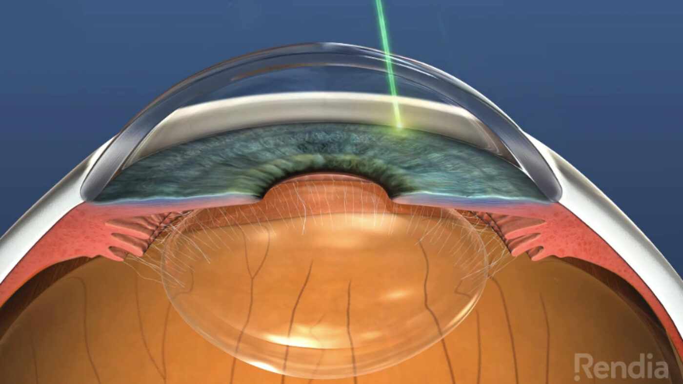 Laser Procedures for Glaucoma