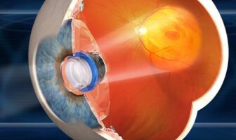 The Implantable Miniature Telescope for Macular Degeneration