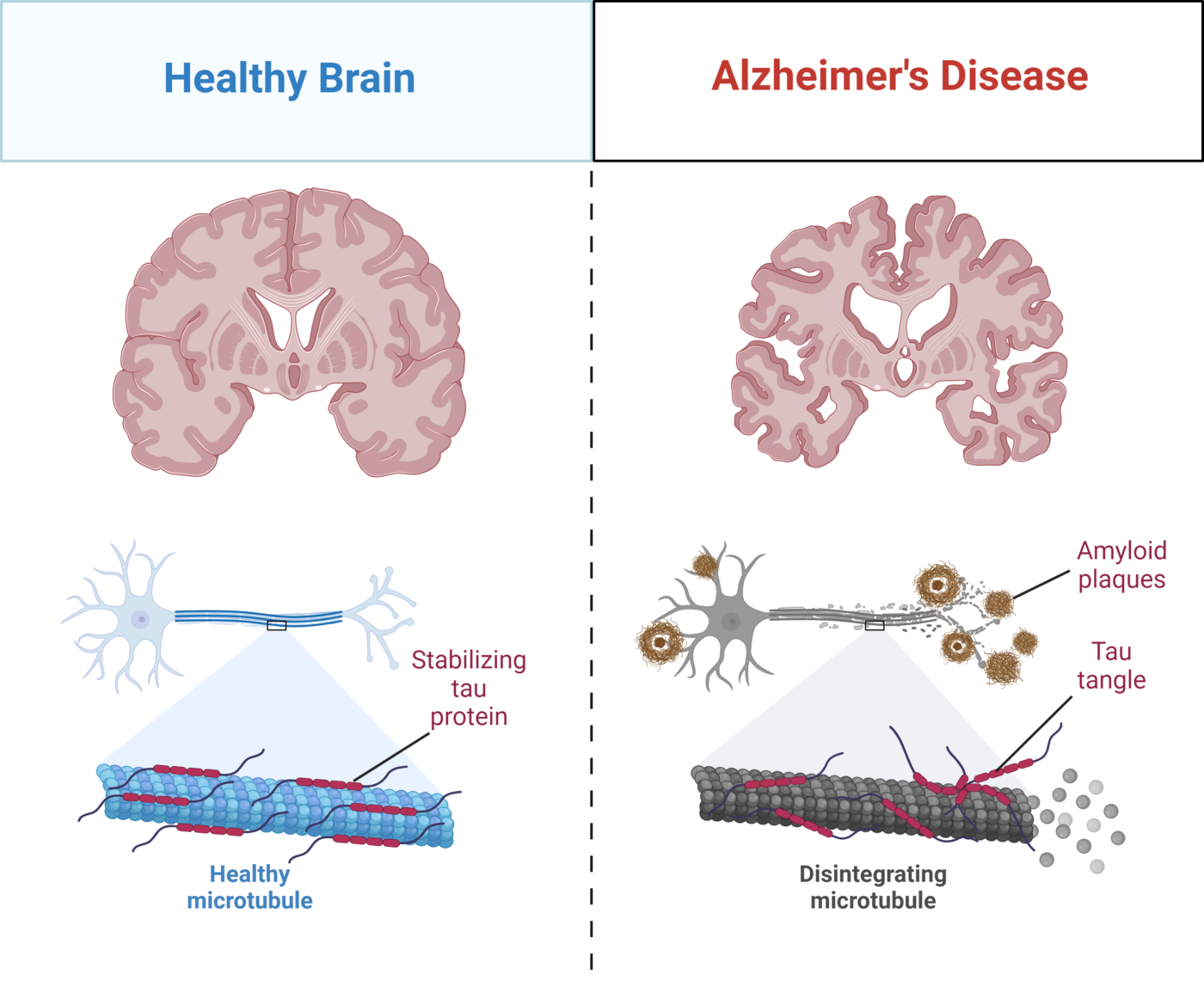 How Does Alzheimer’s Disease Affect the Brain?