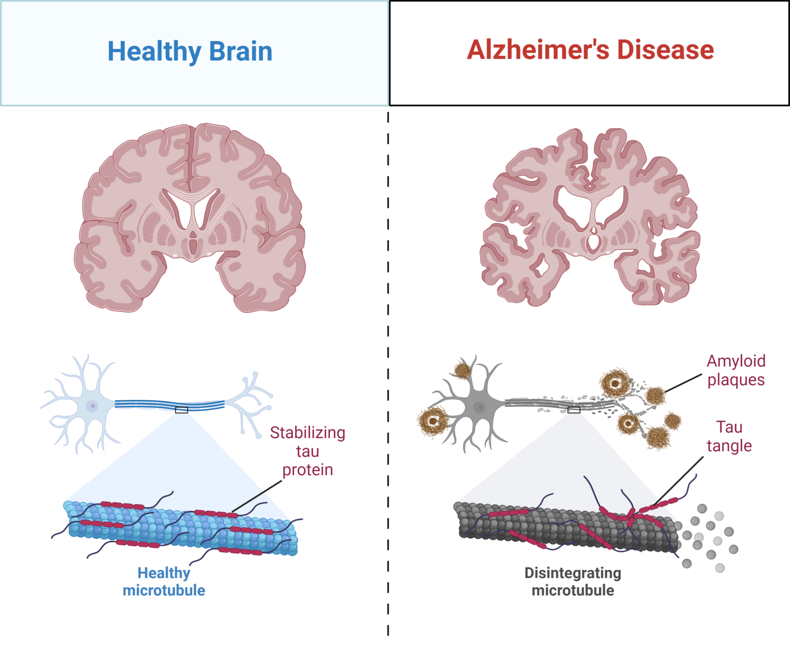 How Does Alzheimer’s Disease Affect the Brain?