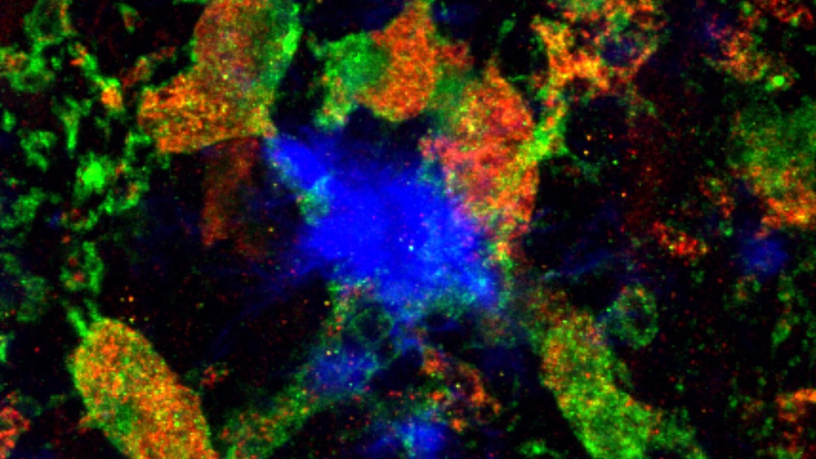 New Evidence on How TREM2 Gene and Mutations Impact Alzheimer’s