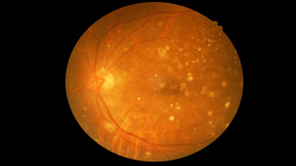 Facts & Figures | Macular Degeneration | BrightFocus Foundation
