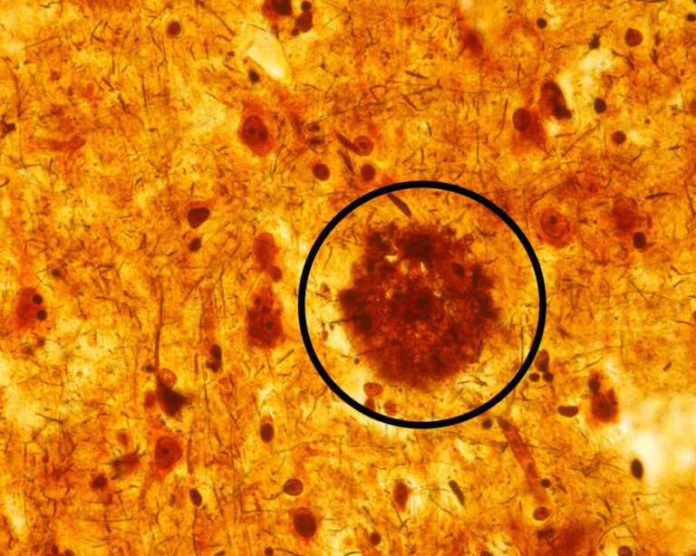 What are Alzheimer’s Plaques and Tangles?