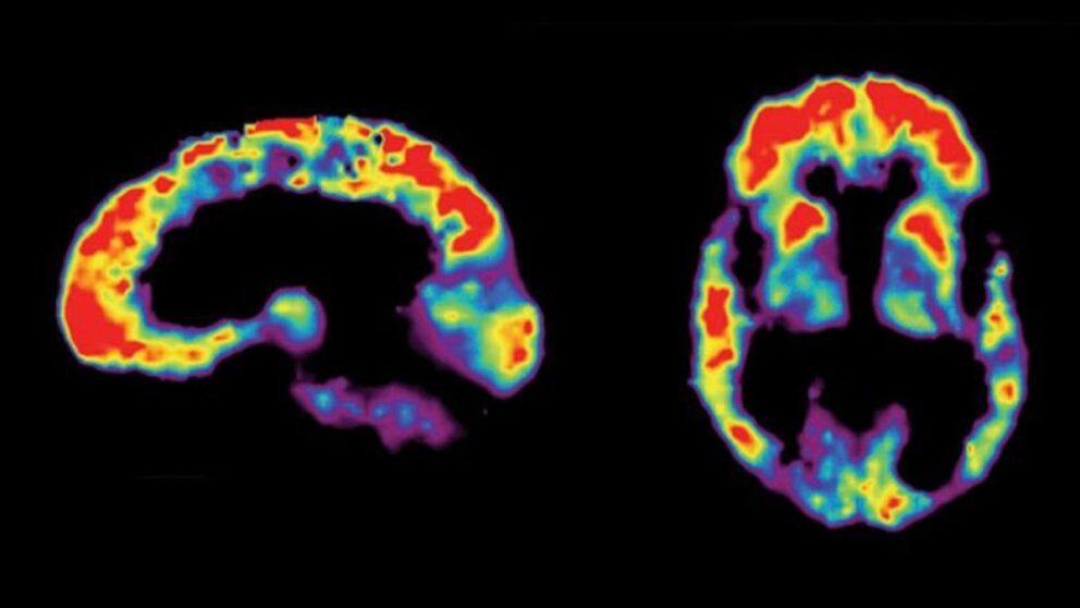 Amyloid PET Scans: A Diagnostic Game-Changer