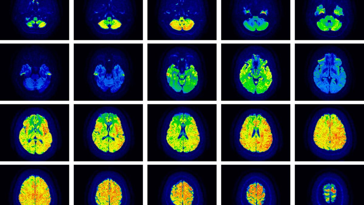 Alzheimer's Disease Research Request for Proposals | BrightFocus Foundation