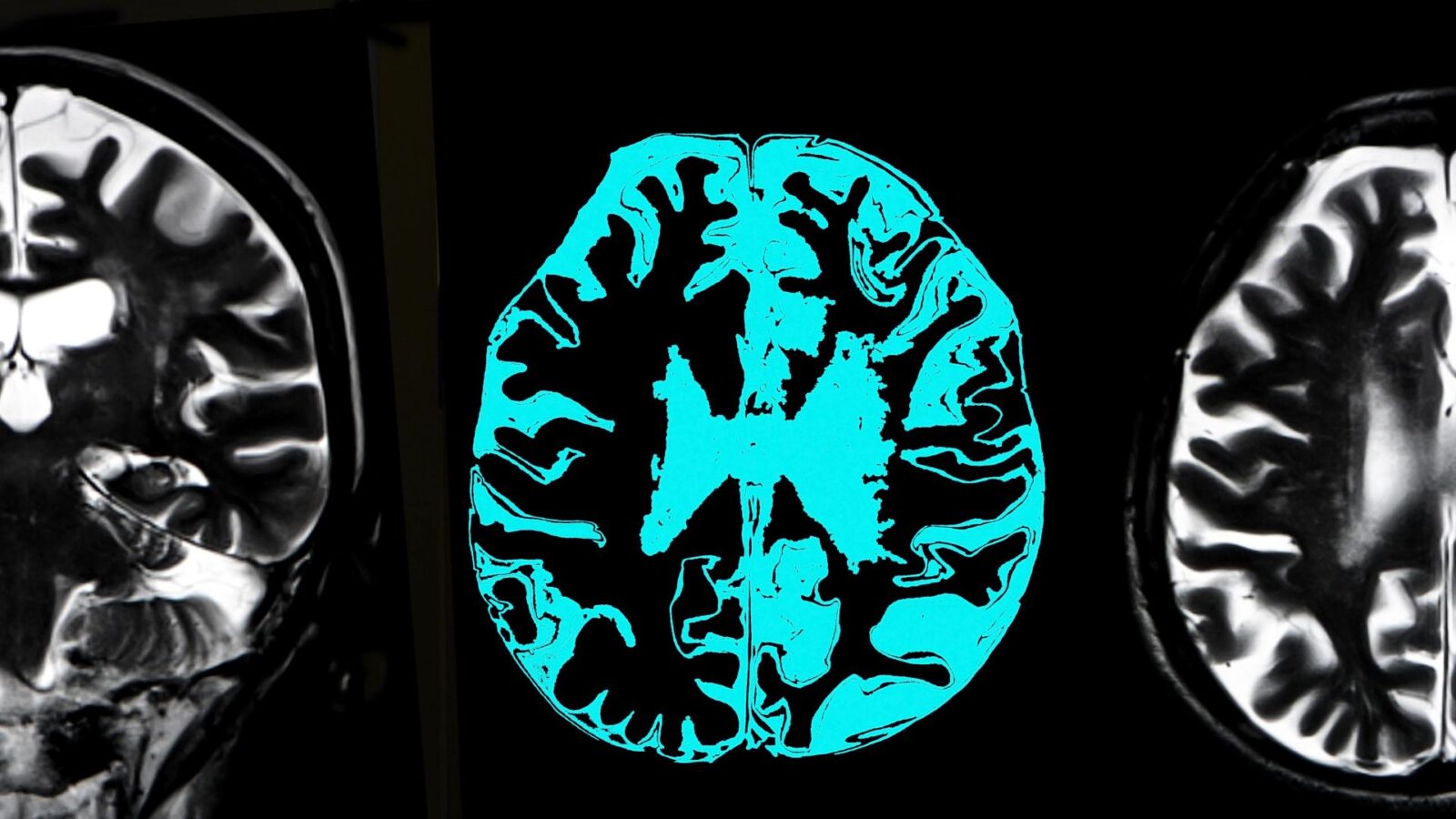 Breaking News Dispatch: A Non-Invasive Alzheimer's Treatment, Early ...