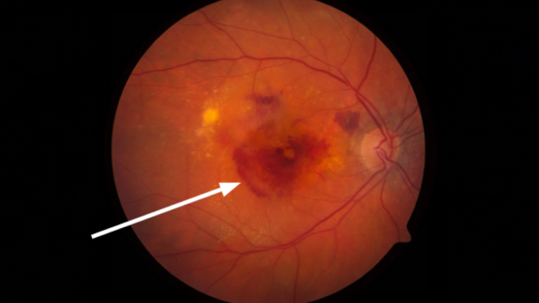 What is Choroidal Neovascularization?