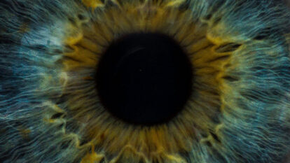 Pigmentary Glaucoma and Pigment Dispersion Syndrome