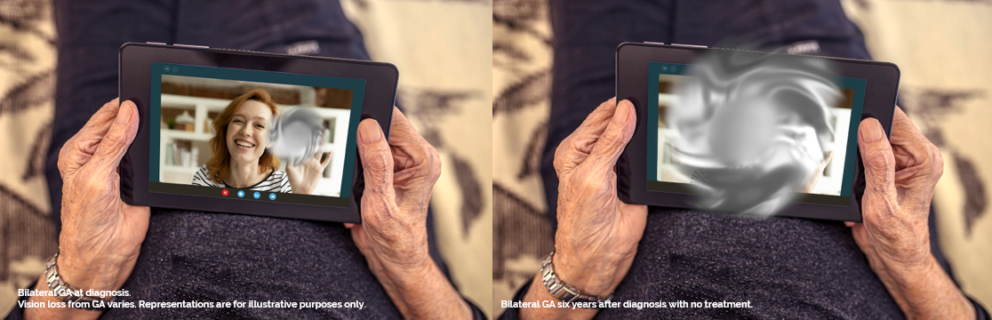 FDA Approves First and Only Treatment for Geographic Atrophy, an ...