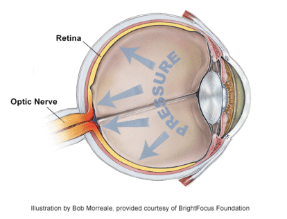 Glaucoma and Eye Pressure