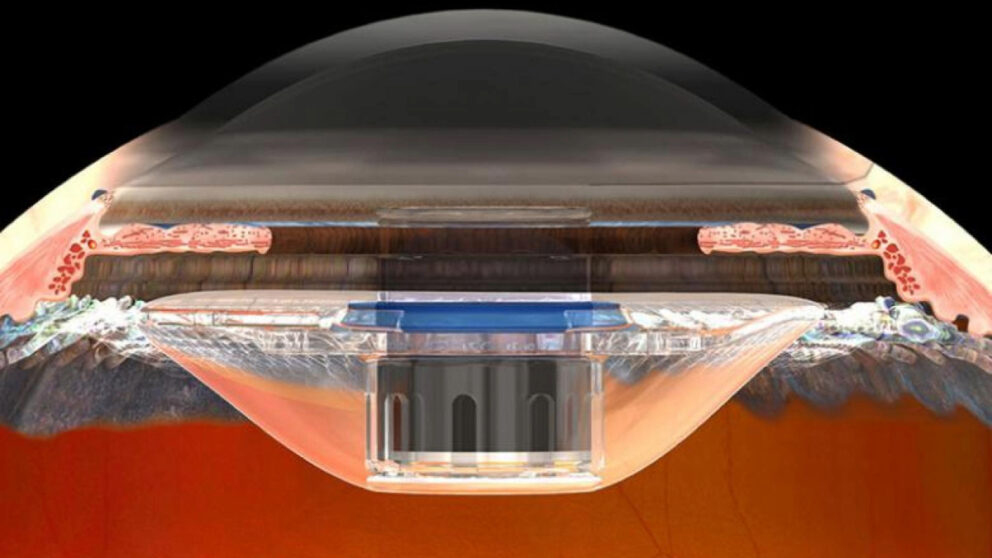 The Implantable Miniature Telescope for Macular Degeneration