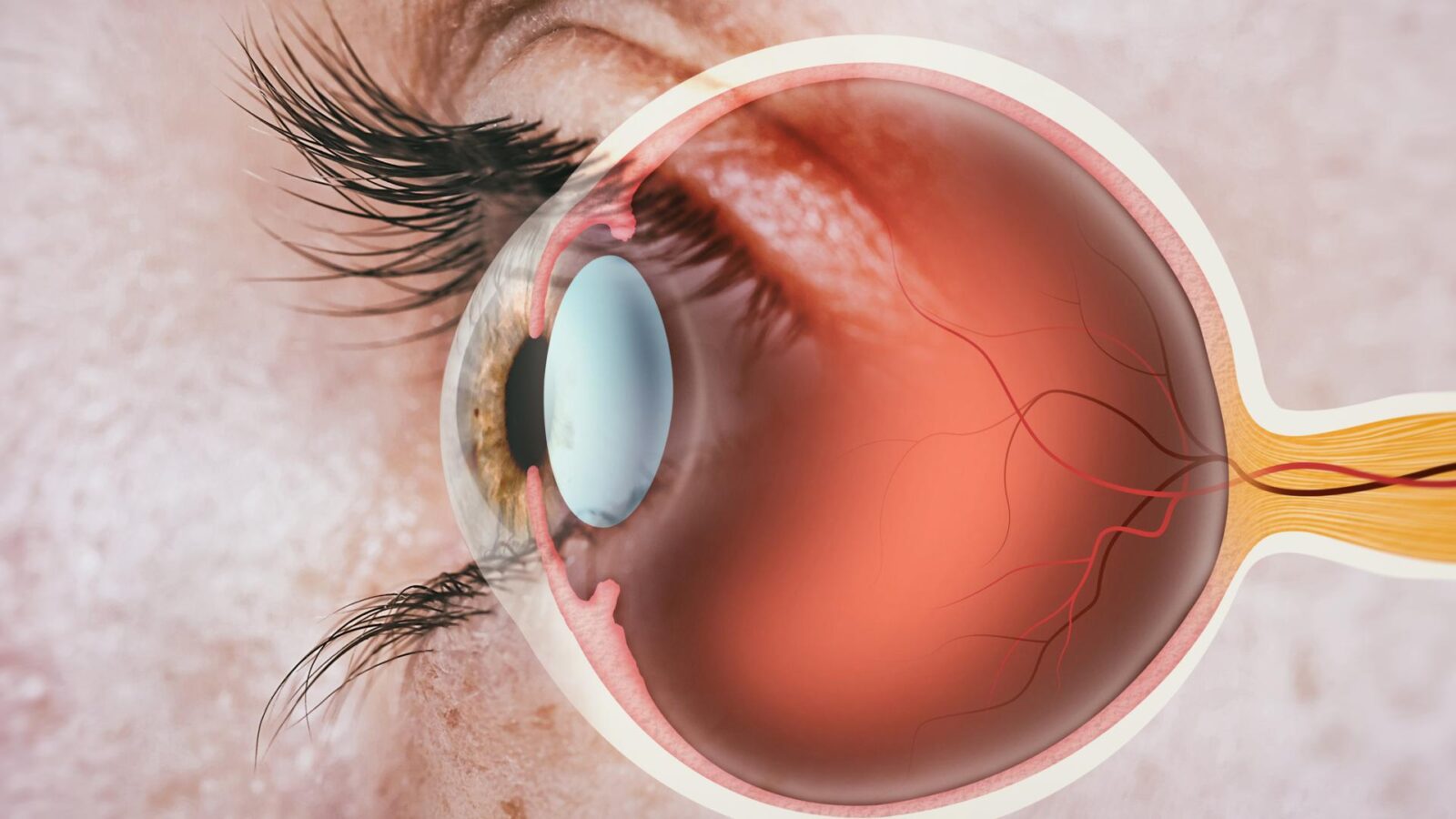 Can you have glaucoma without having increased pressure inside the eye?