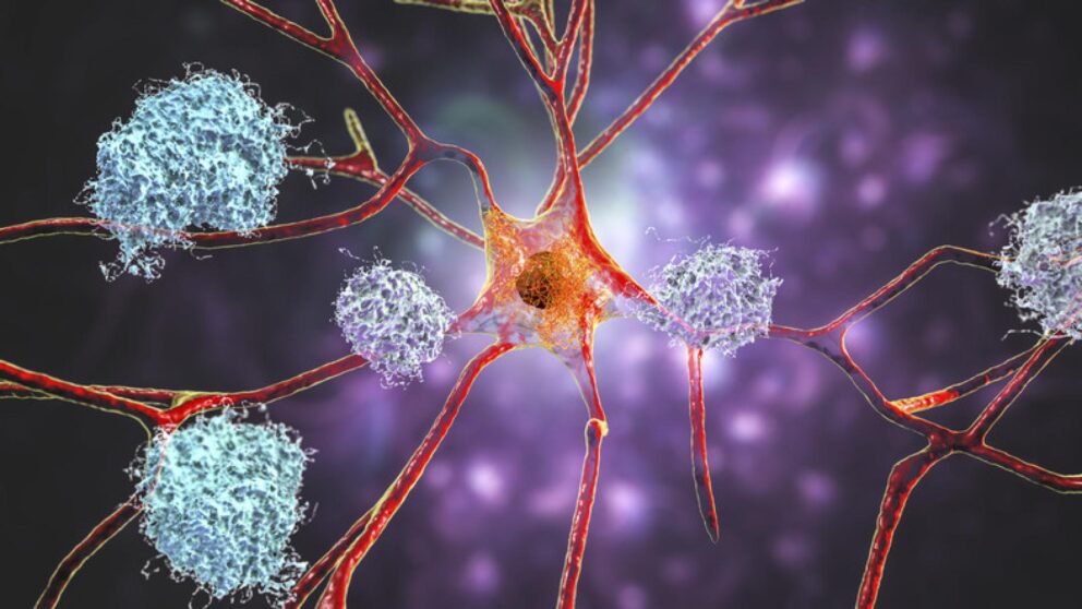 What are Alzheimer’s Plaques and Tangles?