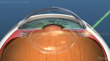 Glaucoma Surgery Series: Cyclophotocoagulation