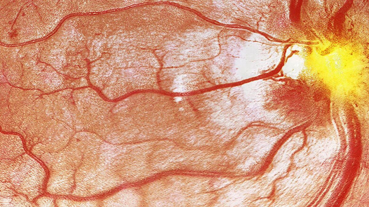 Optical Coherence Tomography Angiography Based Assessment of Retinal ...
