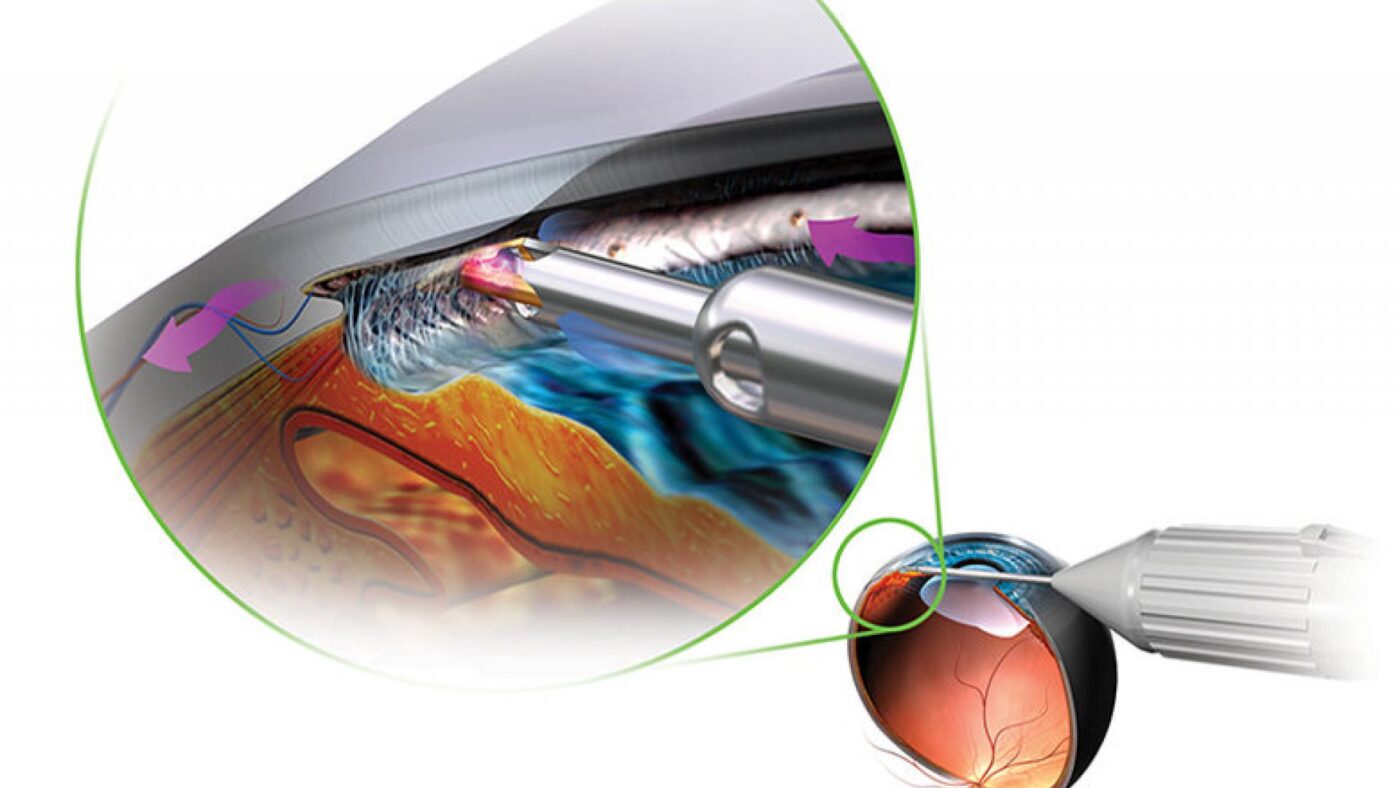 Trabectome Surgery and Glaucoma
