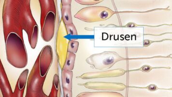 What Causes Macular Drusen?