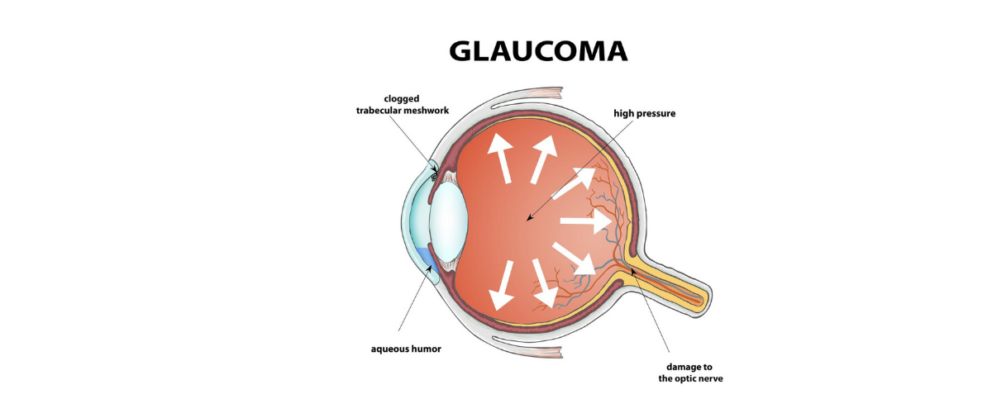 Glaucoma Signs & Symptoms | BrightFocus Foundation
