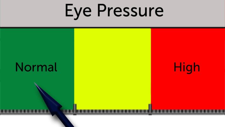 Normal-Tension Glaucoma