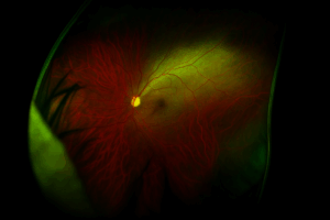 Harnessing Artificial Intelligence to Transform Glaucoma Detection