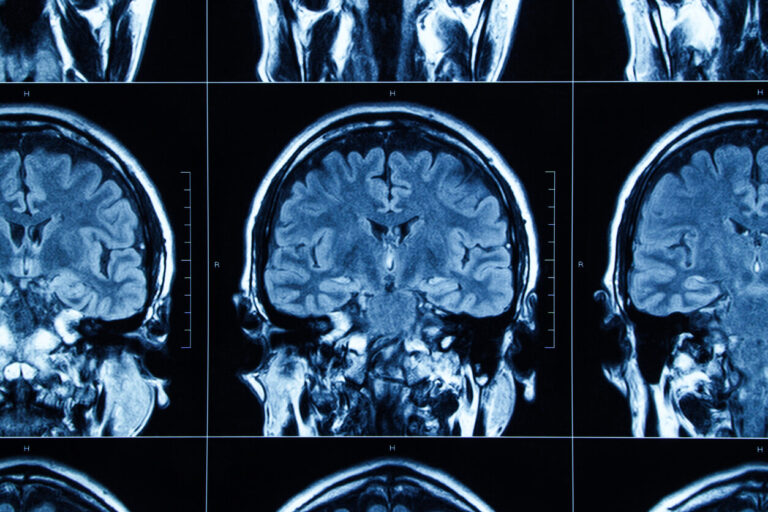 BIO-HERMES-002: Innovative Study to Advance Precise Alzheimer's Diagnosis